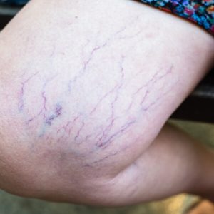 Quels sont les symptômes d'une mauvaise circulation du sang